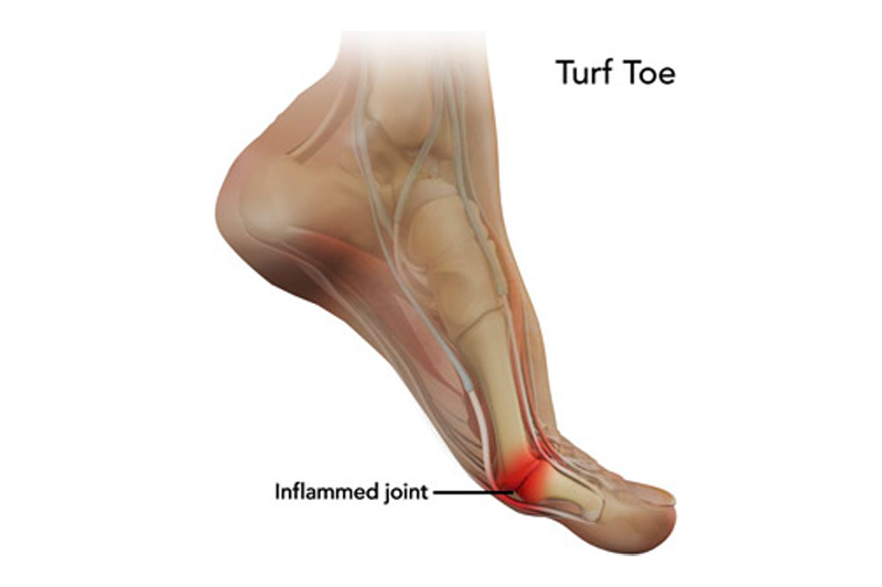 Sports Injuries - Kaitlin Neary MD